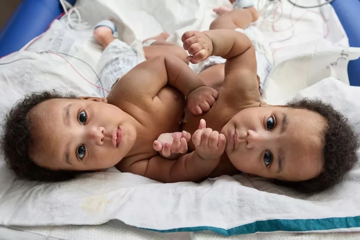 ¡Increíble! Gemelos siameses separados con éxito